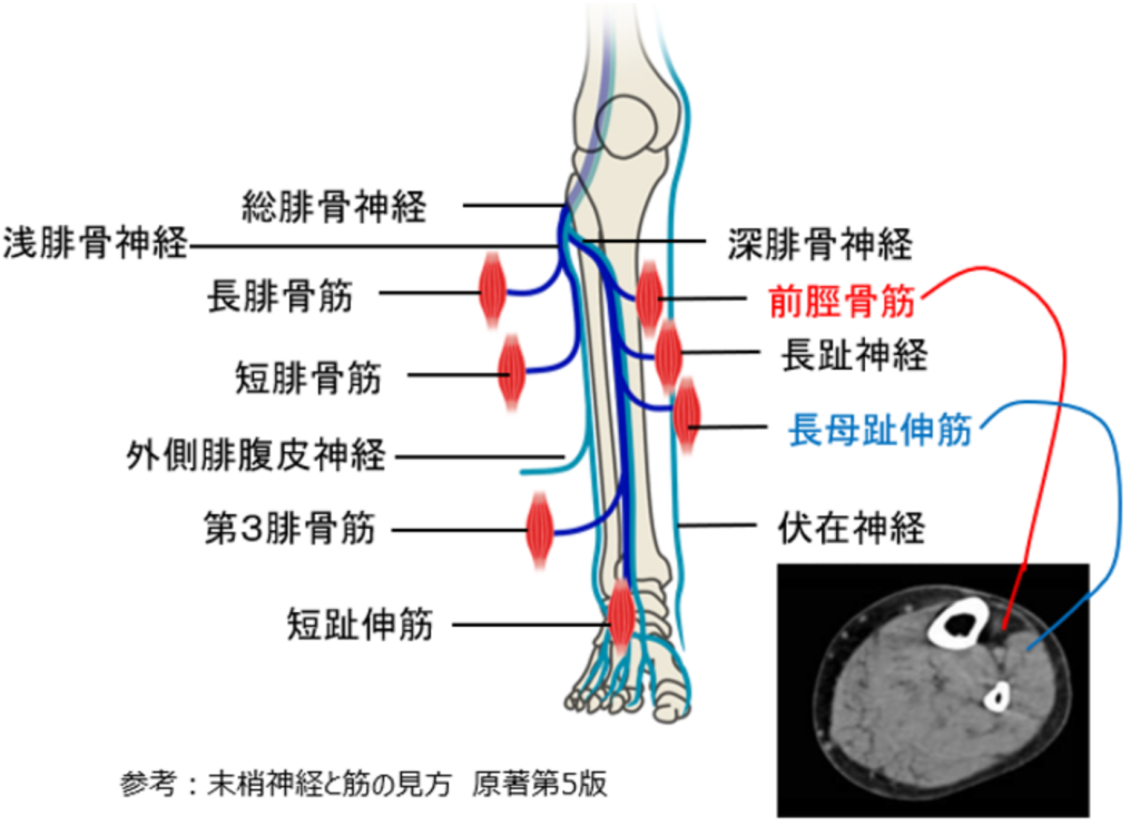 画像からみたGNEミオパチー｜詳しく専門的に知りたい方へ｜一般・患者の皆さま｜ノーベルファーマ株式会社